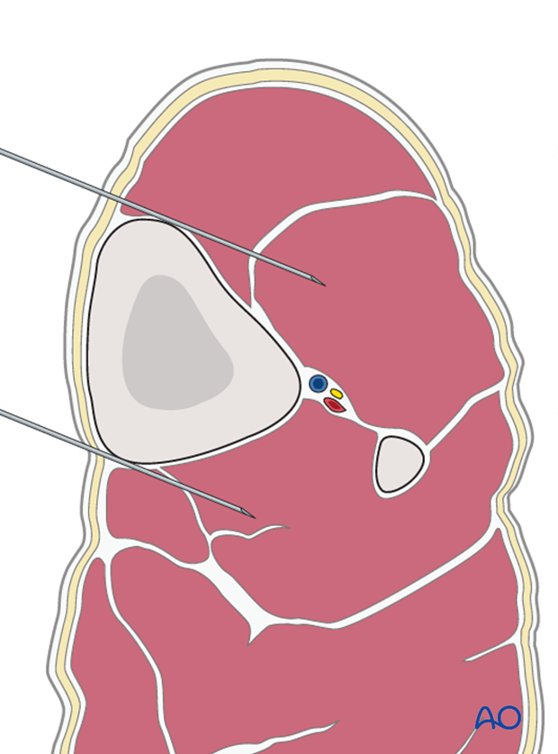 External fixator for Several reducible wedges in the tibial diaphysis