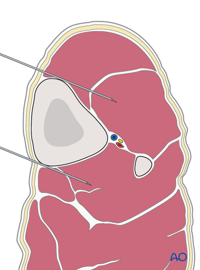 External fixator for Incomplete fracture of the tibia or complete ...