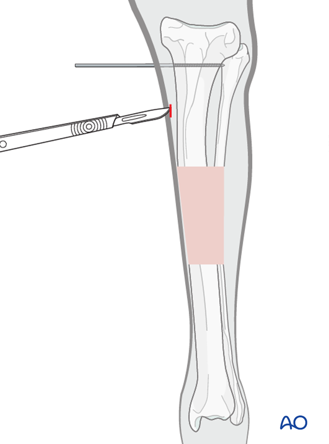External fixator for Incomplete fracture of the tibia or complete ...