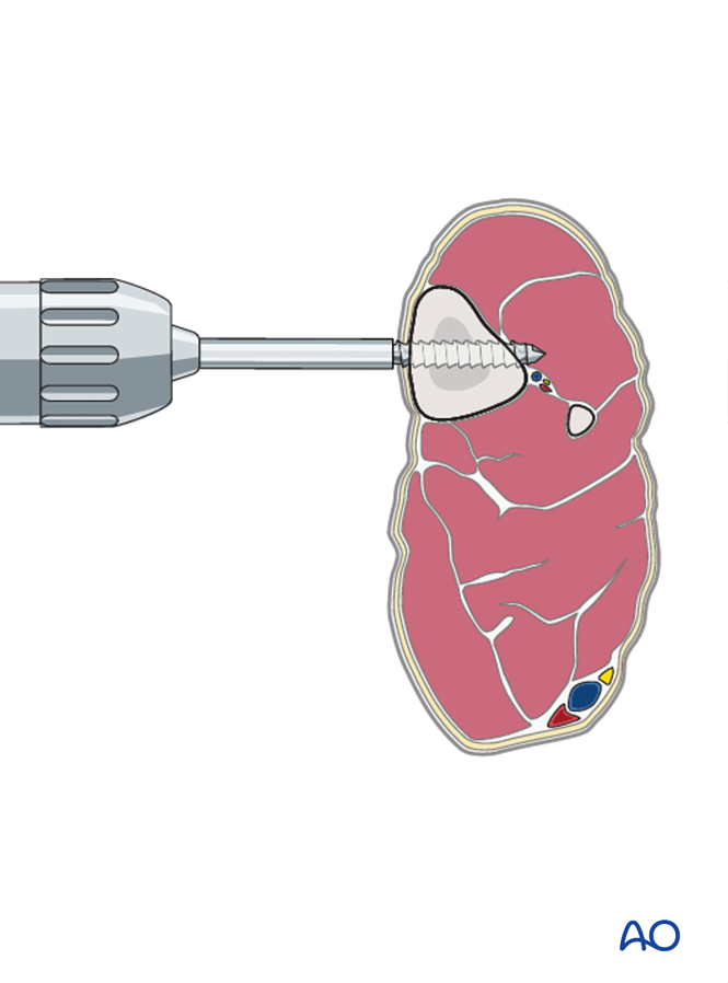 External fixator for Incomplete fracture of the tibia or complete ...