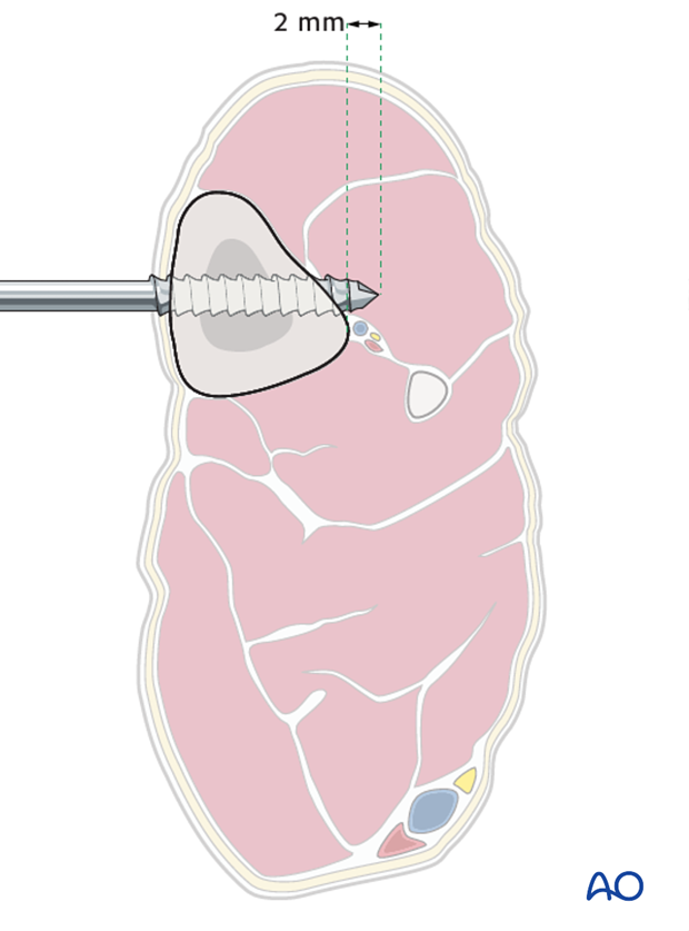 External fixator for Several reducible wedges in the tibial diaphysis