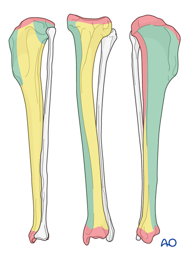 External fixator for Several reducible wedges in the tibial diaphysis