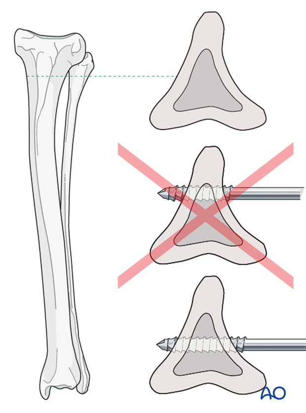 External fixator for Incomplete fracture of the tibia or complete ...