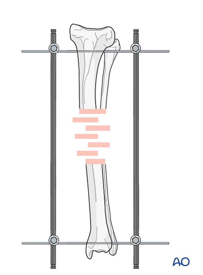 External fixator for Incomplete fracture of the tibia or complete ...