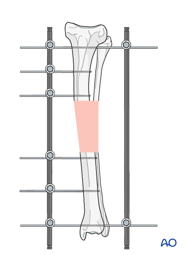 External fixator for Incomplete fracture of the tibia or complete ...