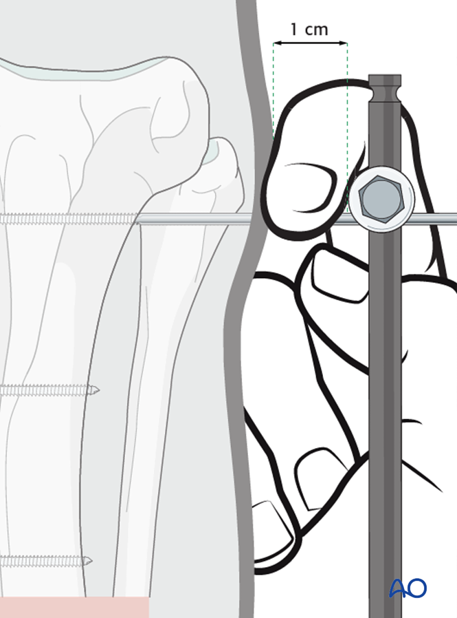 External fixator for Incomplete fracture of the tibia or complete ...