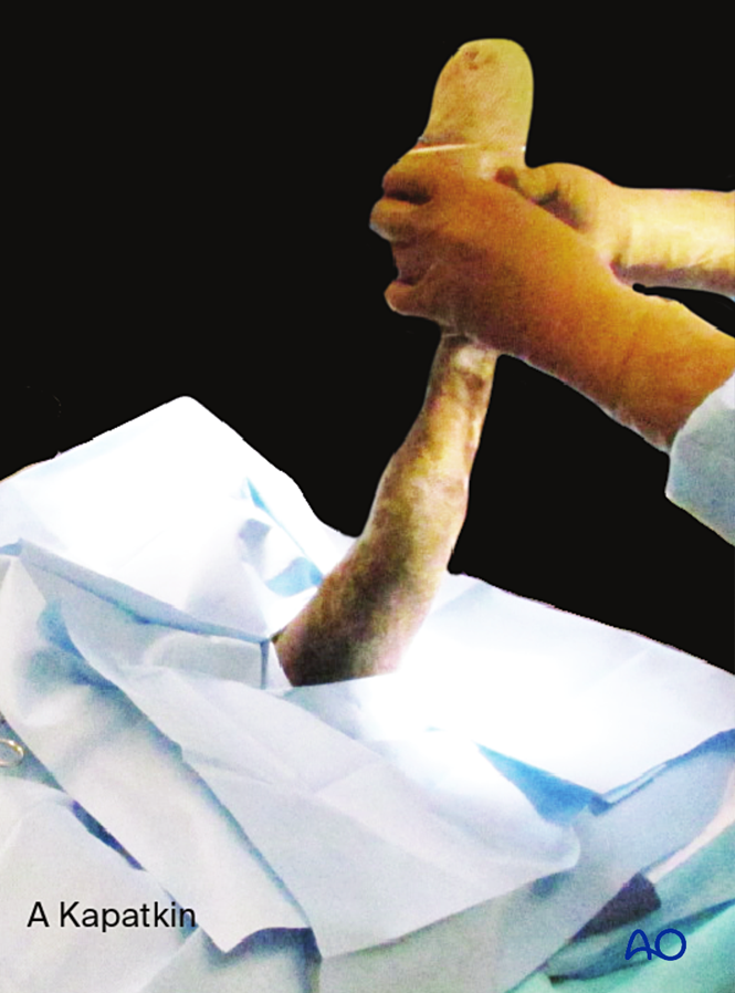 Lateral oblique recumbency