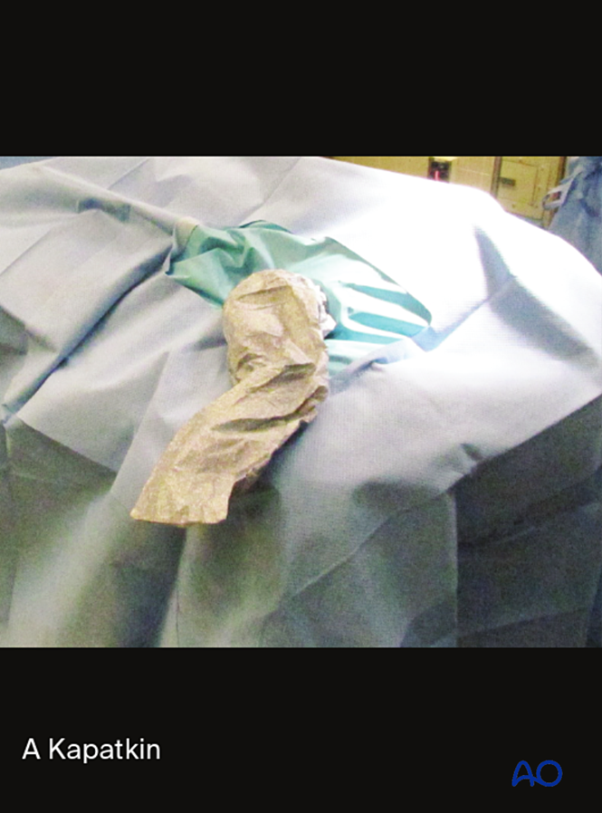 Lateral oblique recumbency