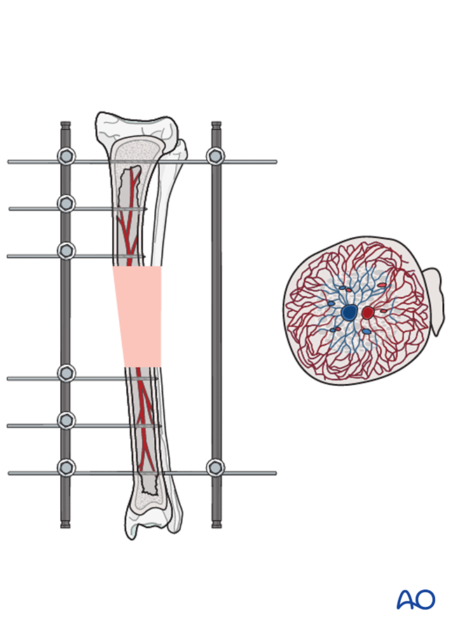 General considerations on external skeletal fixators