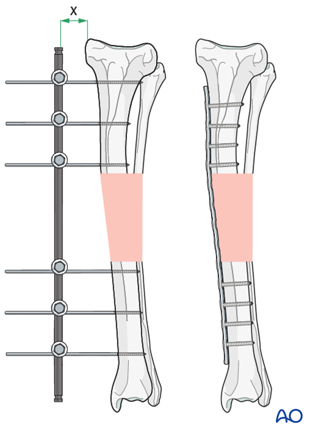 General considerations on external skeletal fixators