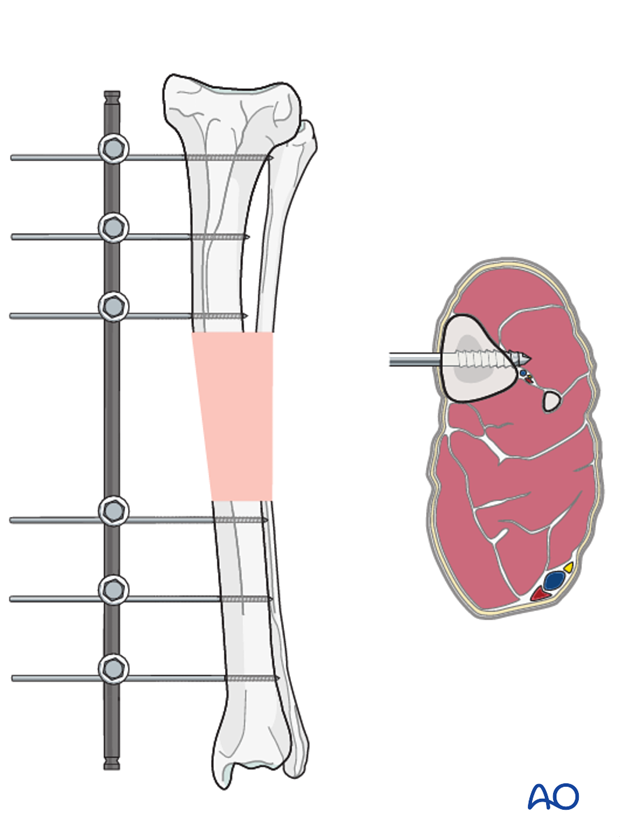 General considerations on external skeletal fixators