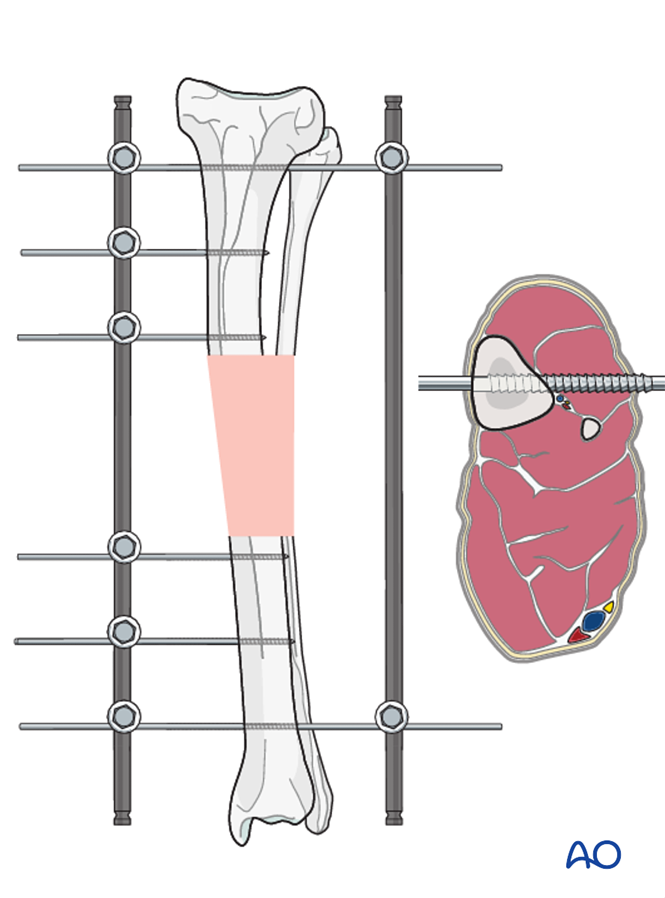 General considerations on external skeletal fixators