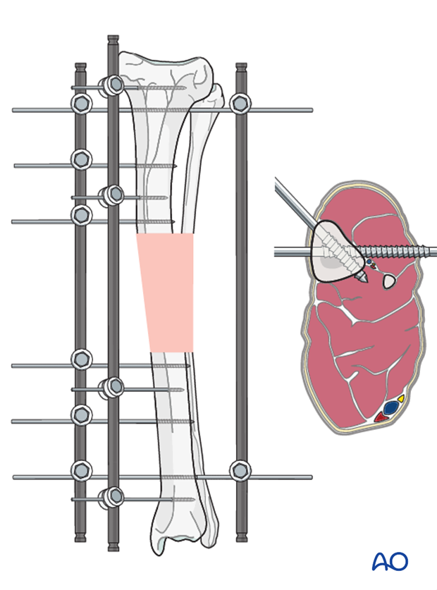 General considerations on external skeletal fixators