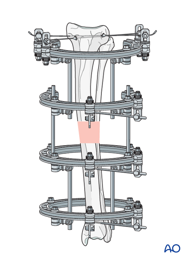 General considerations on external skeletal fixators