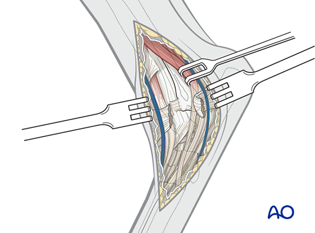 Screw fixation of the lateral malleolus for Partial articular lateral ...