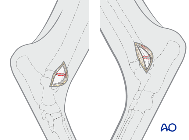 All approaches to the distal tibia