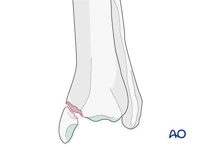 Partial articular medial malleolar fracture of the distal tibia