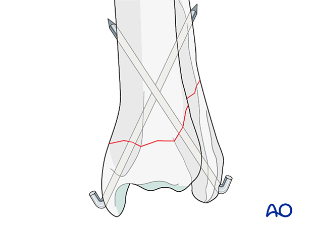 Cross pinning for Simple extraarticular fracture of the distal tibia