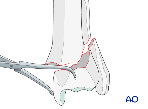 Cross pinning for Simple extraarticular fracture of the distal tibia
