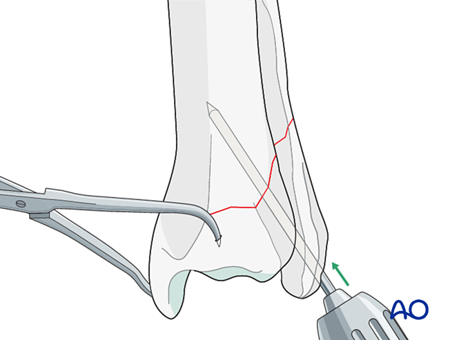 Cross pinning for Simple extraarticular fracture of the distal tibia