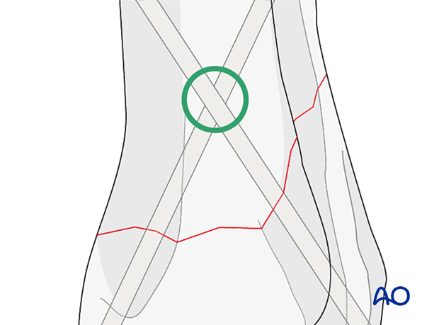 Cross pinning for Simple extraarticular fracture of the distal tibia