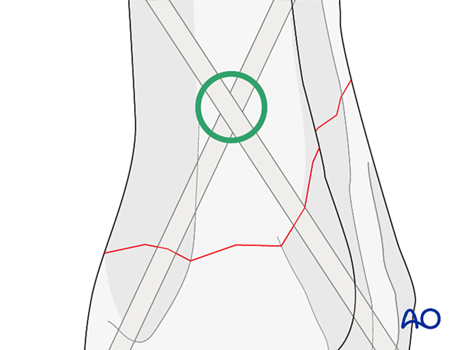 Cross pinning for Simple extraarticular fracture of the distal tibia