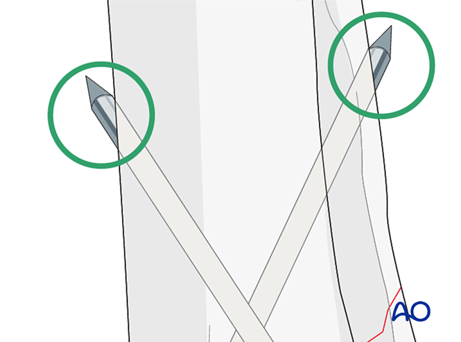 Cross pinning for Simple extraarticular fracture of the distal tibia