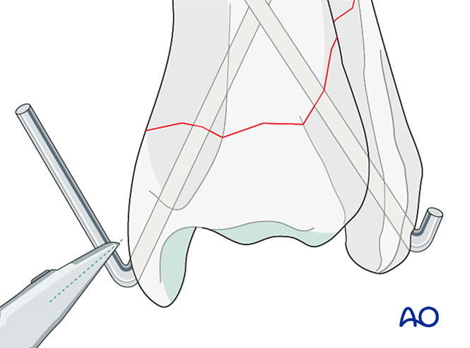 Cross pinning for Simple extraarticular fracture of the distal tibia