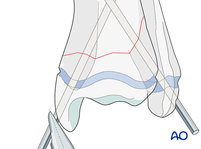 Cross pinning for Simple extraarticular fracture of the distal tibia