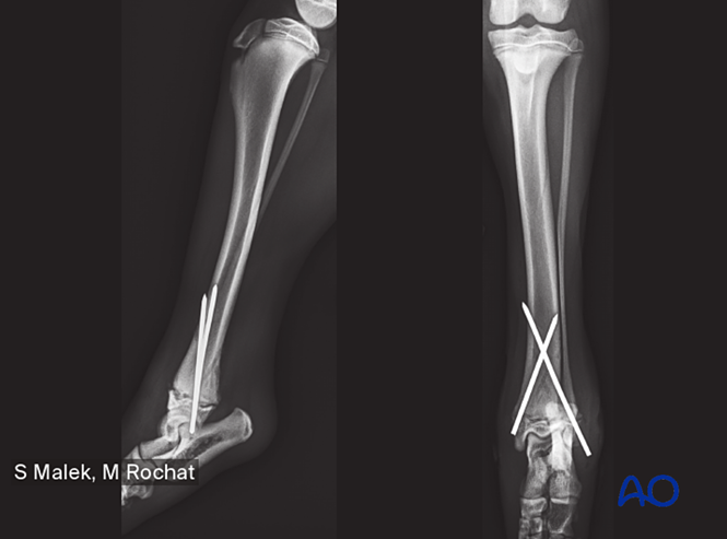 Cross pinning for Simple extraarticular fracture of the distal tibia
