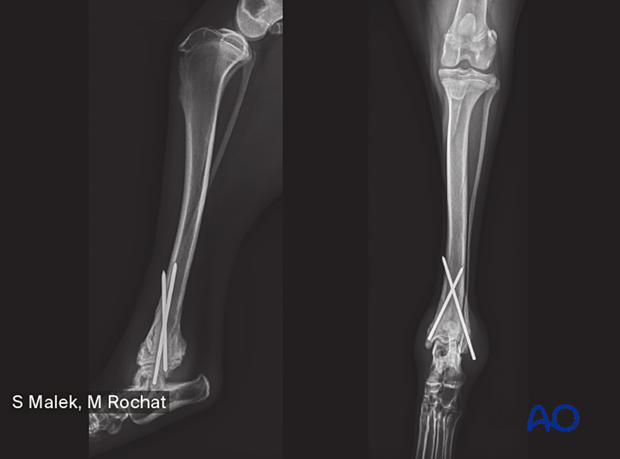 Cross pinning for Simple extraarticular fracture of the distal tibia