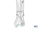 Treatment of Simple extraarticular fracture of the distal tibia