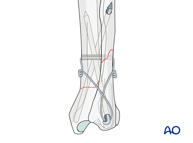 Cross pinning with tension band fixation for Simple extraarticular ...