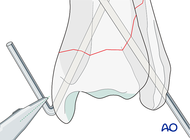 Cross pinning with tension band fixation for Simple extraarticular ...