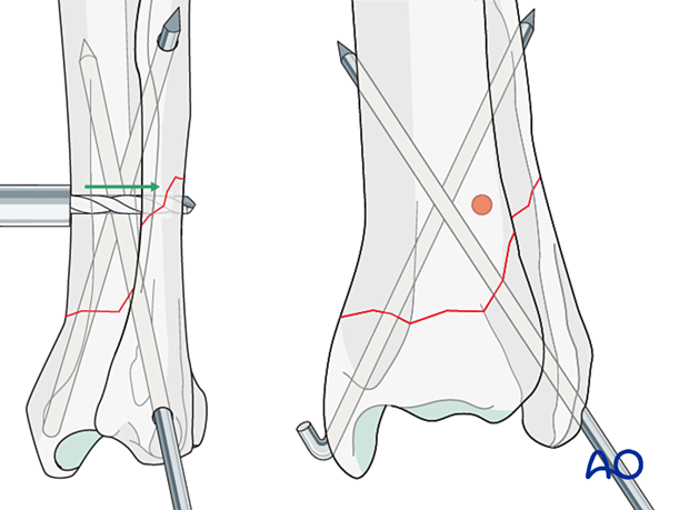 Cross pinning with tension band fixation for Simple extraarticular ...