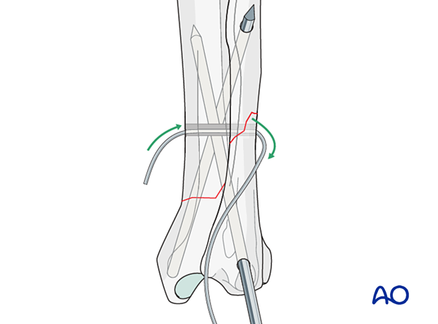 Cross pinning with tension band fixation for Simple extraarticular ...