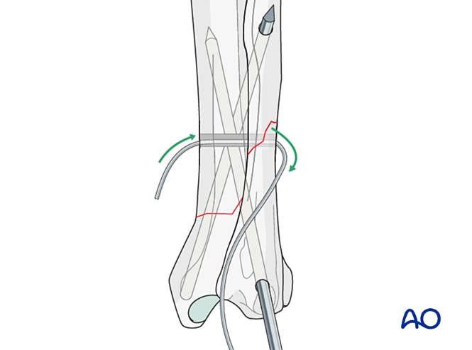 Cross pinning with tension band fixation for Simple extraarticular ...