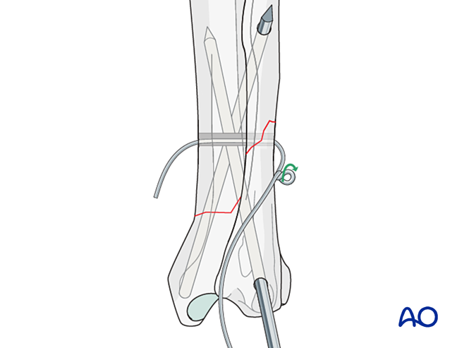 Cross pinning with tension band fixation for Simple extraarticular ...