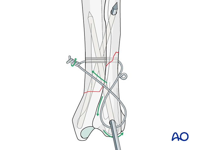 Cross pinning with tension band fixation for Simple extraarticular ...