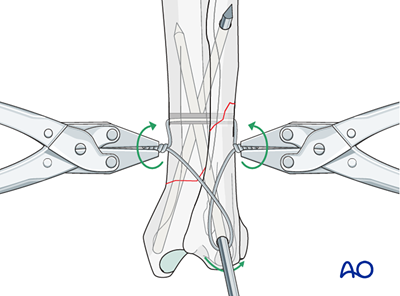 Cross pinning with tension band fixation for Simple extraarticular ...