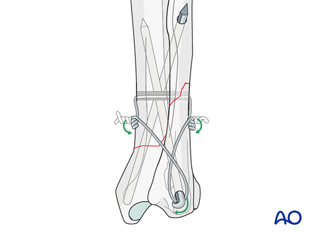 Cross pinning with tension band fixation for Simple extraarticular ...