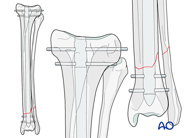 Interlocking nail fixation for Simple extraarticular fracture of the ...