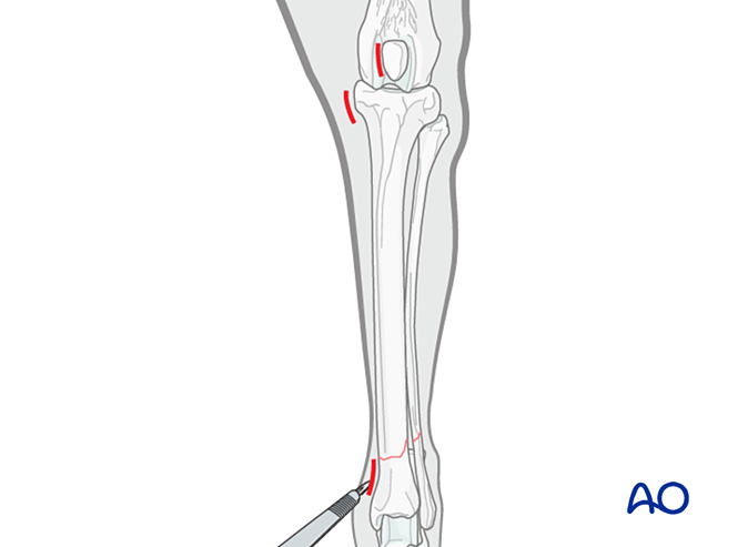 Interlocking nail fixation for Simple extraarticular fracture of the ...