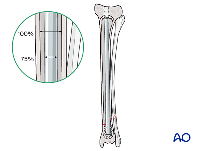 Interlocking nail fixation for Simple extraarticular fracture of the ...