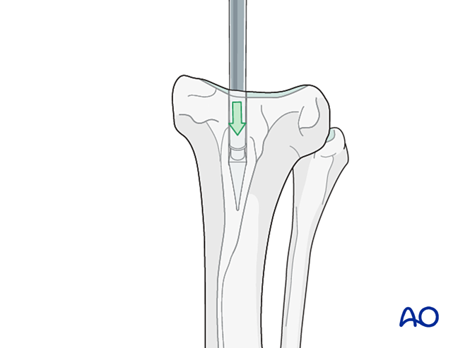 Interlocking nail fixation for Simple extraarticular fracture of the ...