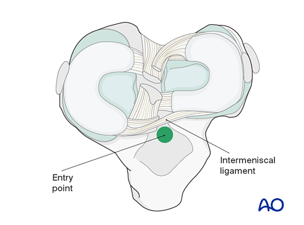 Interlocking nail fixation for Simple extraarticular fracture of the ...