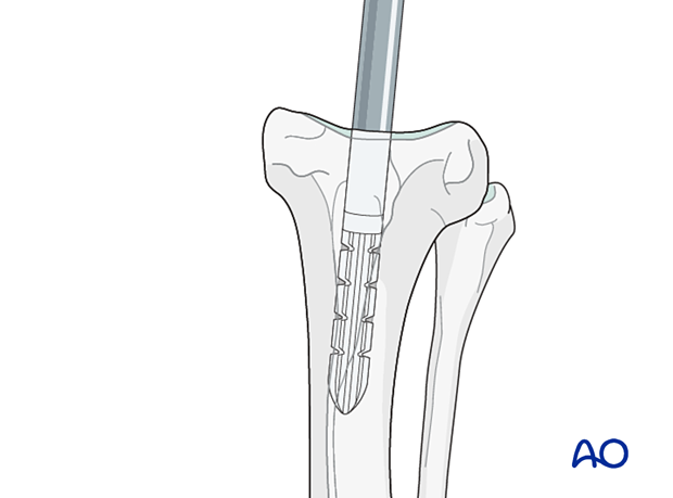 Interlocking nail fixation for Simple extraarticular fracture of the ...