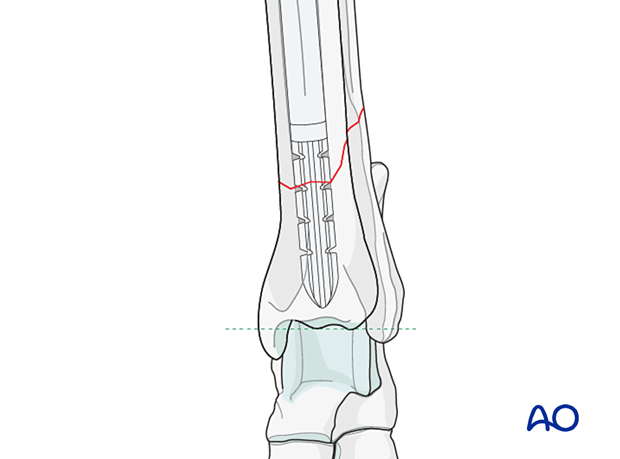 Interlocking nail fixation for Simple extraarticular fracture of the ...