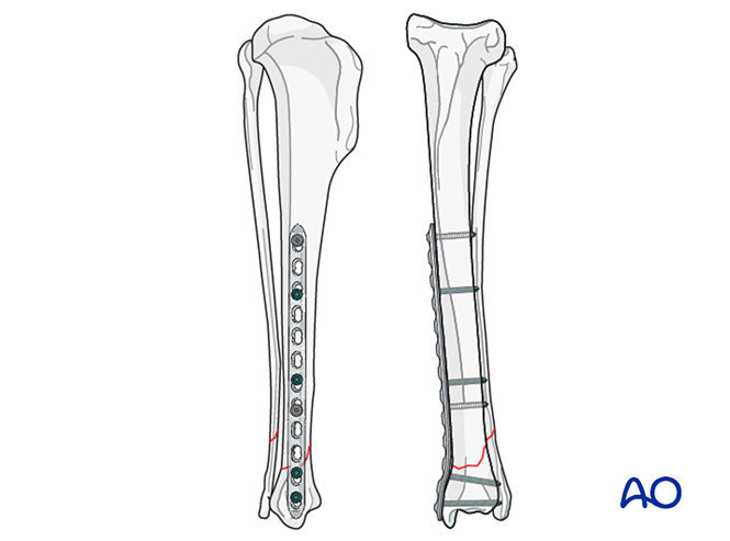 Medial plating for Simple extraarticular fracture of the distal tibia