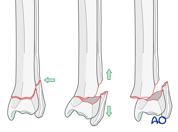 Cross pinning for Simple extraarticular fracture of the distal tibia